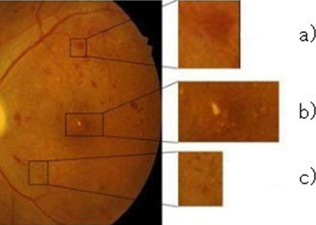 Detection of Exudates and Microaneurysms in the Retina by Segmentation ...