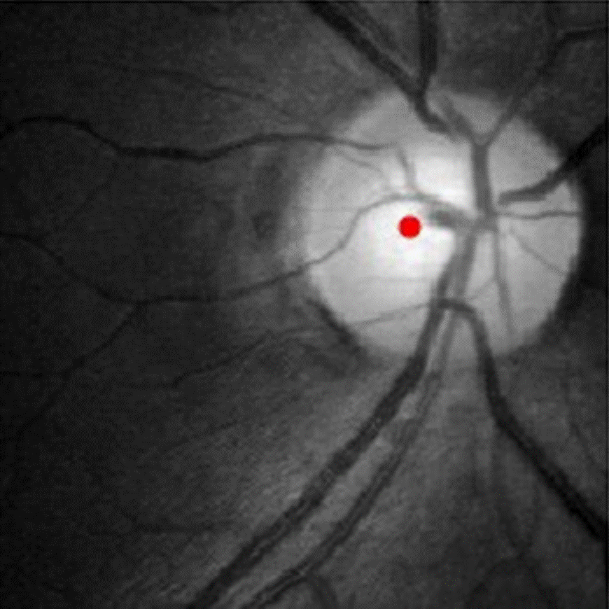 Image-based Glaucoma Classification Using Fundus Images and Deep Learning