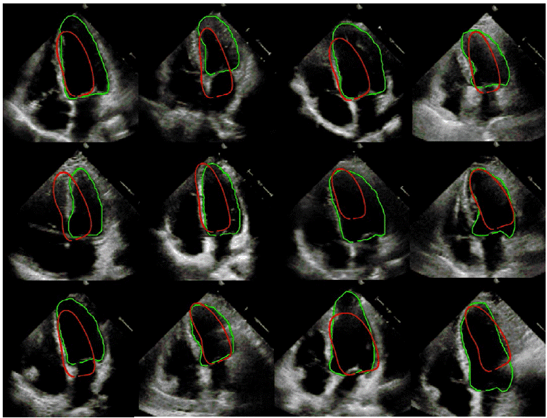 A U-Net with Statistical Shape Restrictions Applied to the Segmentation ...