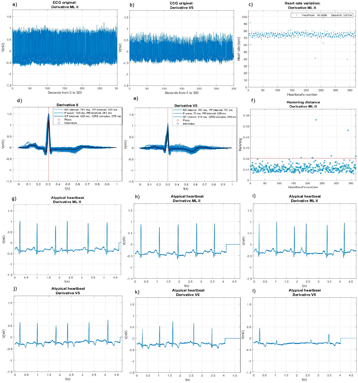 A Novel Detector of Atypical Beats for Early Diagnosis of Heart ...