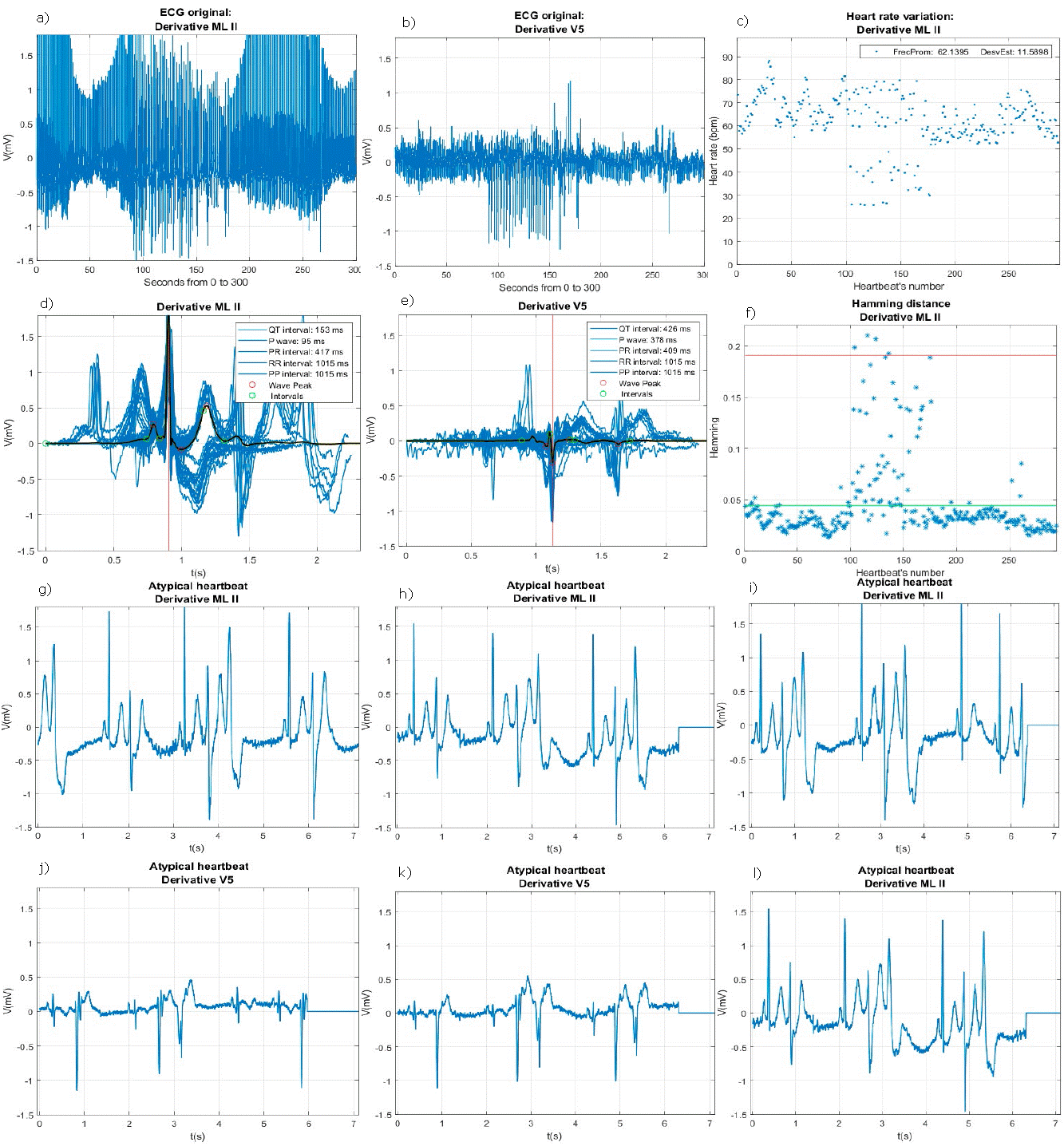 A Novel Detector of Atypical Beats for Early Diagnosis of Heart ...