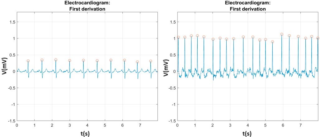 A Novel Detector of Atypical Beats for Early Diagnosis of Heart ...
