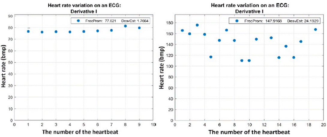 A Novel Detector of Atypical Beats for Early Diagnosis of Heart ...