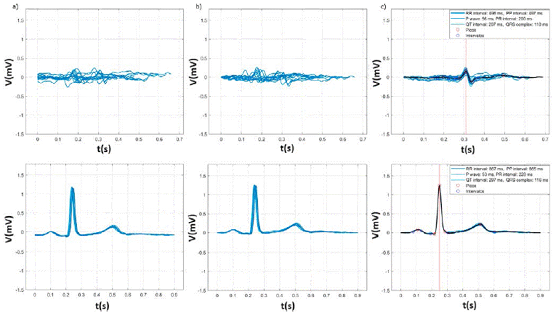 A Novel Detector of Atypical Beats for Early Diagnosis of Heart ...