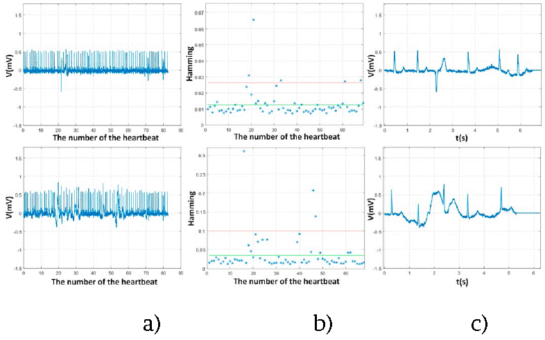 A Novel Detector of Atypical Beats for Early Diagnosis of Heart ...