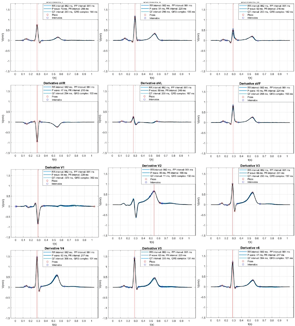 A Novel Detector of Atypical Beats for Early Diagnosis of Heart ...