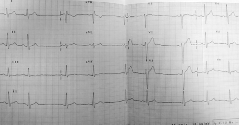 Coartación aórtica: una causa infradiagnosticada de hipertensión ...