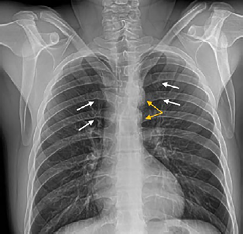 Coartación aórtica: una causa infradiagnosticada de hipertensión ...