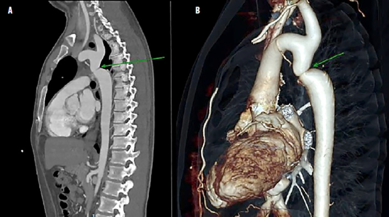 Coartación aórtica: una causa infradiagnosticada de hipertensión ...