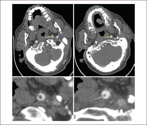 Carotid free-floating thrombus treated with apixaban: report of a case ...