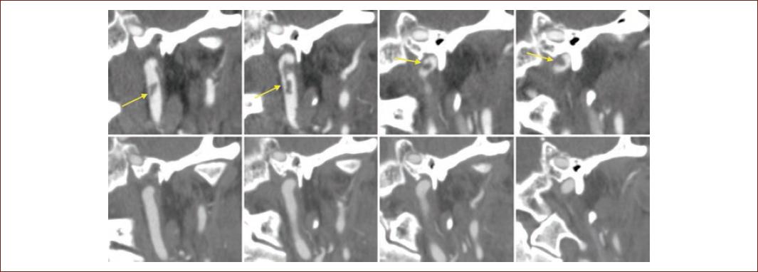 Carotid free-floating thrombus treated with apixaban: report of a case ...