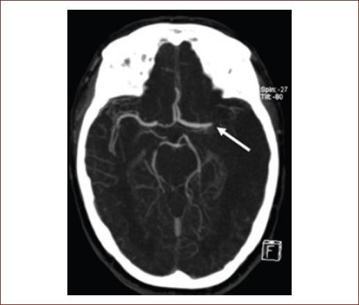 Update on the management of acute stroke. A practical clinical guide