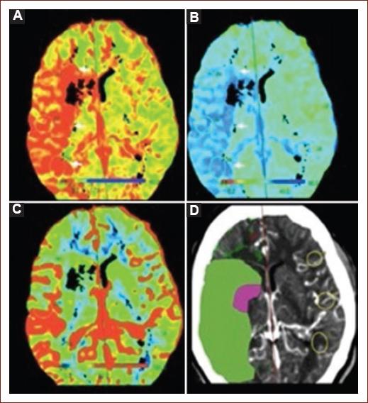Update on the management of acute stroke. A practical clinical guide