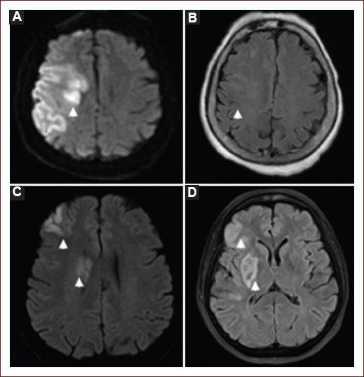 Update on the management of acute stroke. A practical clinical guide