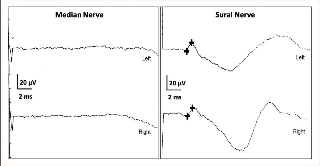 Preservation of sural nerve in classic forms of Guillain-Barré in a ...