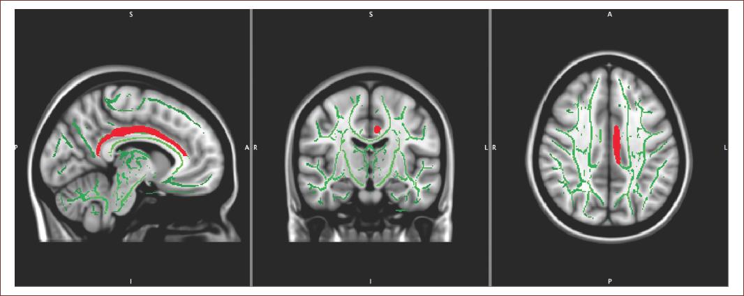 Diffusion tensor imaging (tractography) in elderly people with dementia ...