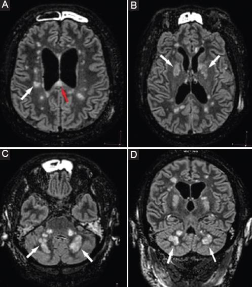 Obstructive sleep apnea (OSA) should be considered a comorbidity as a ...