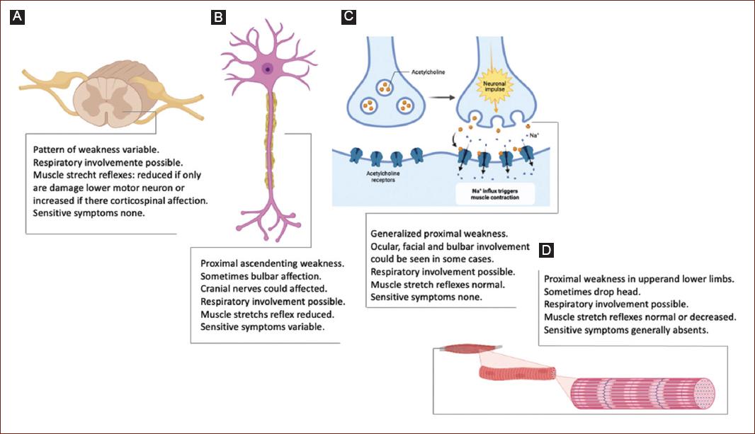 Acute neuromuscular failure acquired in the community: A state-of-the ...