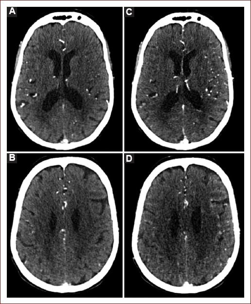 Correlation between dual-phase CTA-SI ASPECTS and automated CT ...