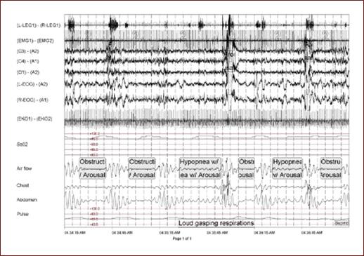 Nocturnal frontal opercular seizures masquerading as catathrenia: a ...