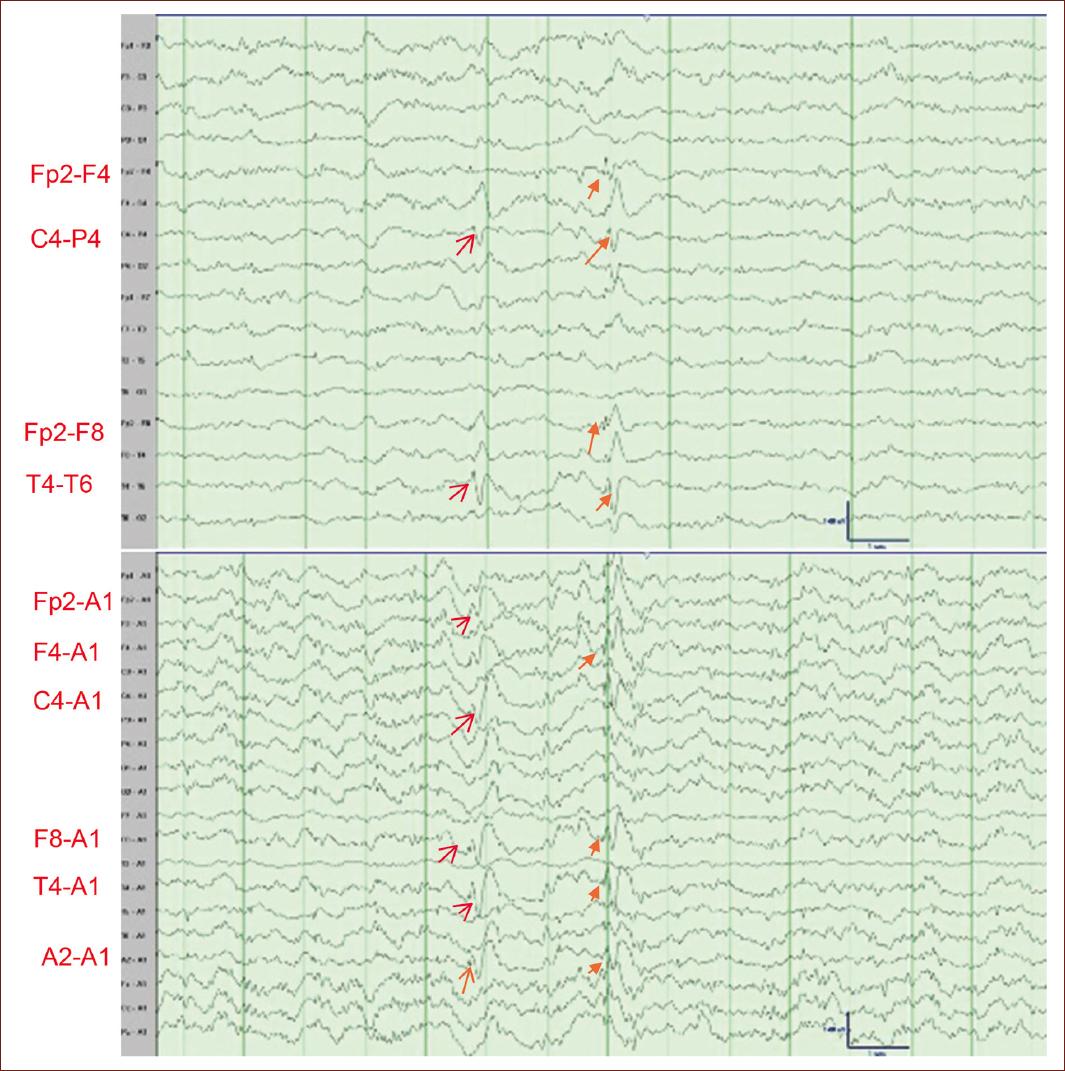 Nocturnal frontal opercular seizures masquerading as catathrenia: a ...