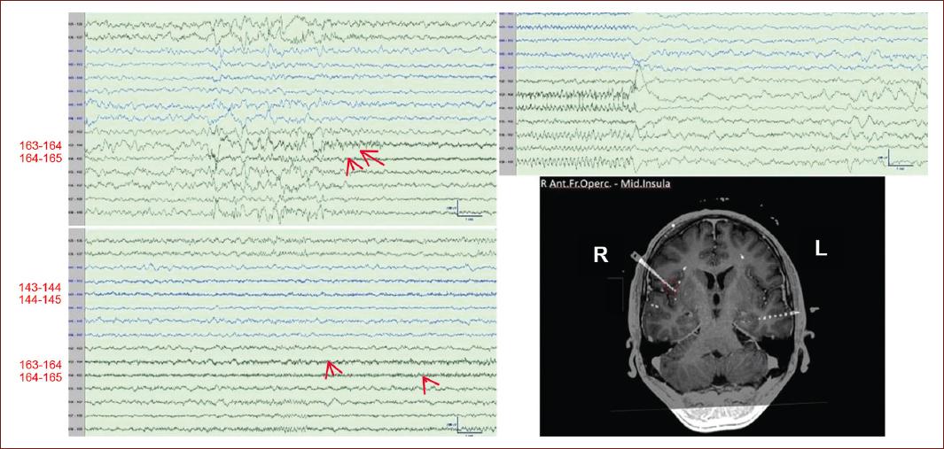 Nocturnal frontal opercular seizures masquerading as catathrenia: a ...