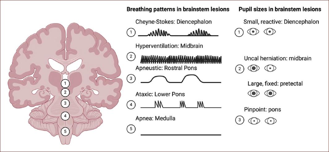 Dazed and confused: the neurological examination of the unconscious patient