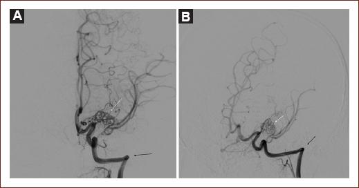 Twig-like middle cerebral artery - pathophysiology and imaging approach