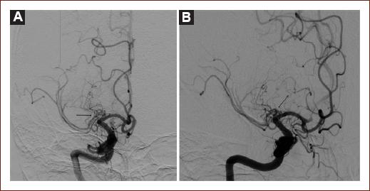 Twig-like middle cerebral artery - pathophysiology and imaging approach