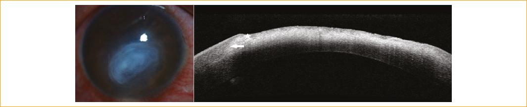 Corneal morphological patterns detected by spectral domain optical ...