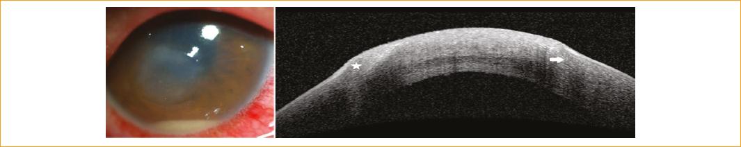 Corneal morphological patterns detected by spectral domain optical ...
