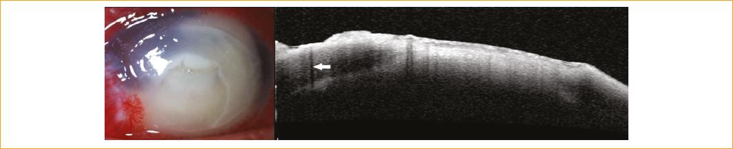 Corneal morphological patterns detected by spectral domain optical ...