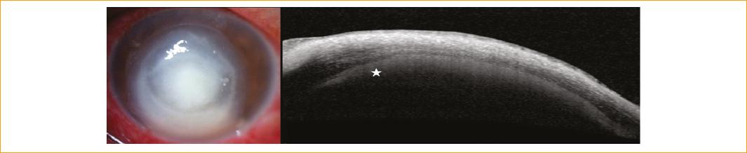 Corneal morphological patterns detected by spectral domain optical ...