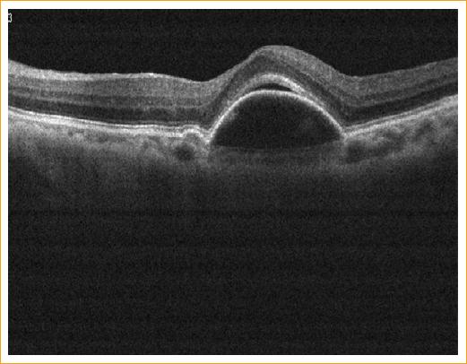 Secondary ocular hypertension as a complication of posterior ...