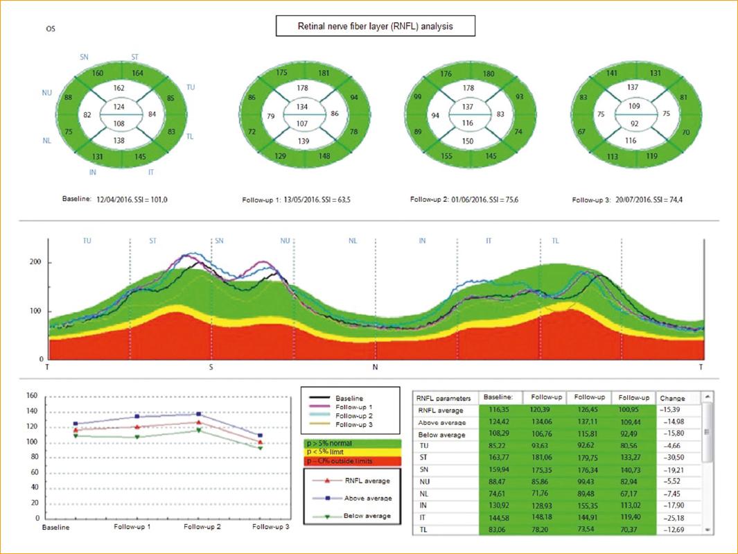 Secondary ocular hypertension as a complication of posterior ...