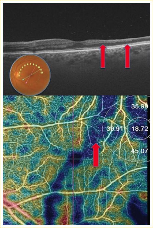 Hallazgos de SS-OCT y OCT-A en pacientes con anemia de células ...