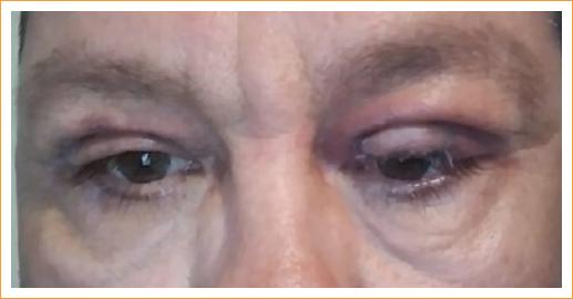 Loxoscelismo necrótico palpebral y reconstrucción con autoinjerto ...