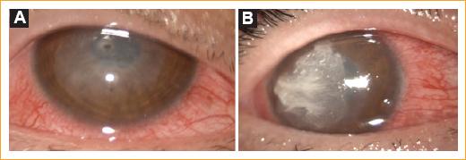 Úlcera corneal por Fonsecaea pedrosoi, las dificultades del tratamiento ...