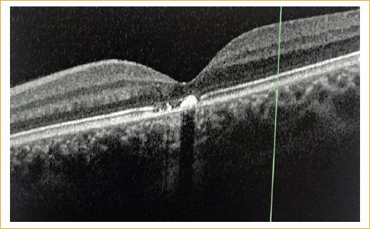 Puntero láser y pacientes pediátricos: un problema actual