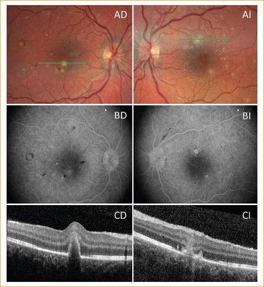 Diagnóstico y manejo de la candidiasis ocular con neovascularización ...