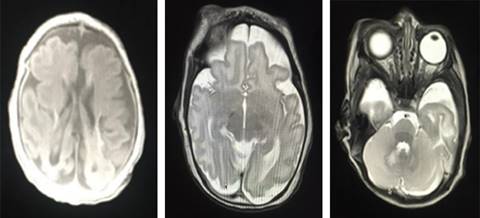 Microcefalia asociada a síndrome de transfusión feto-fetal