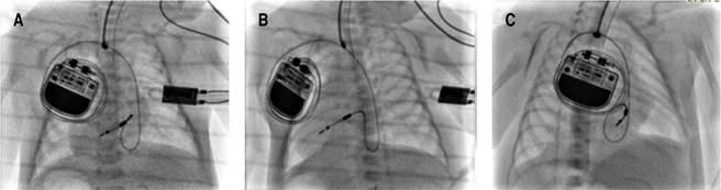 Marcapasos endocárdico en un prematuro con bloqueo AV y situs inversus ...