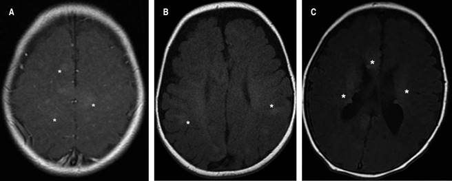 Esclerosis tuberosa: hallazgos clínicos e imagenológicos en una serie ...