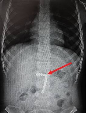 Perforación intestinal secundaria a la ingestión de múltiples imanes en ...
