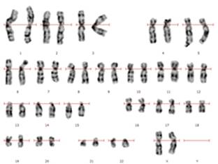Monosomía parcial 10q derivada de inversión paracéntrica de origen materno