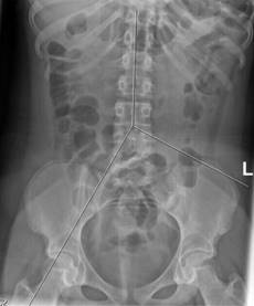 Utilidad de los marcadores colónicos para la clasificación de ...