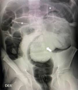 Pólipo gigante como causa de invaginación colo-cólica en paciente escolar