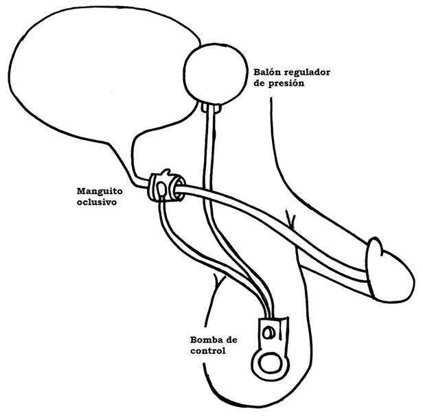 Extrusión del esfínter artificial uretral externo. Caso clínico y ...