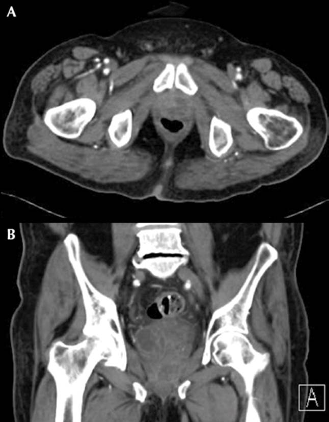 Absceso prostático tratado mediante resección transuretral de próstata ...
