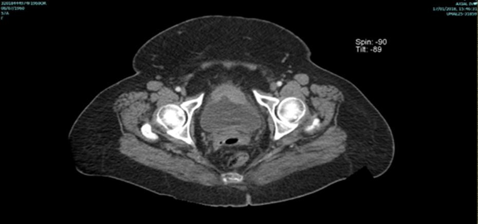Cáncer vesical de células escamosas: reporte de un caso y revisión de ...